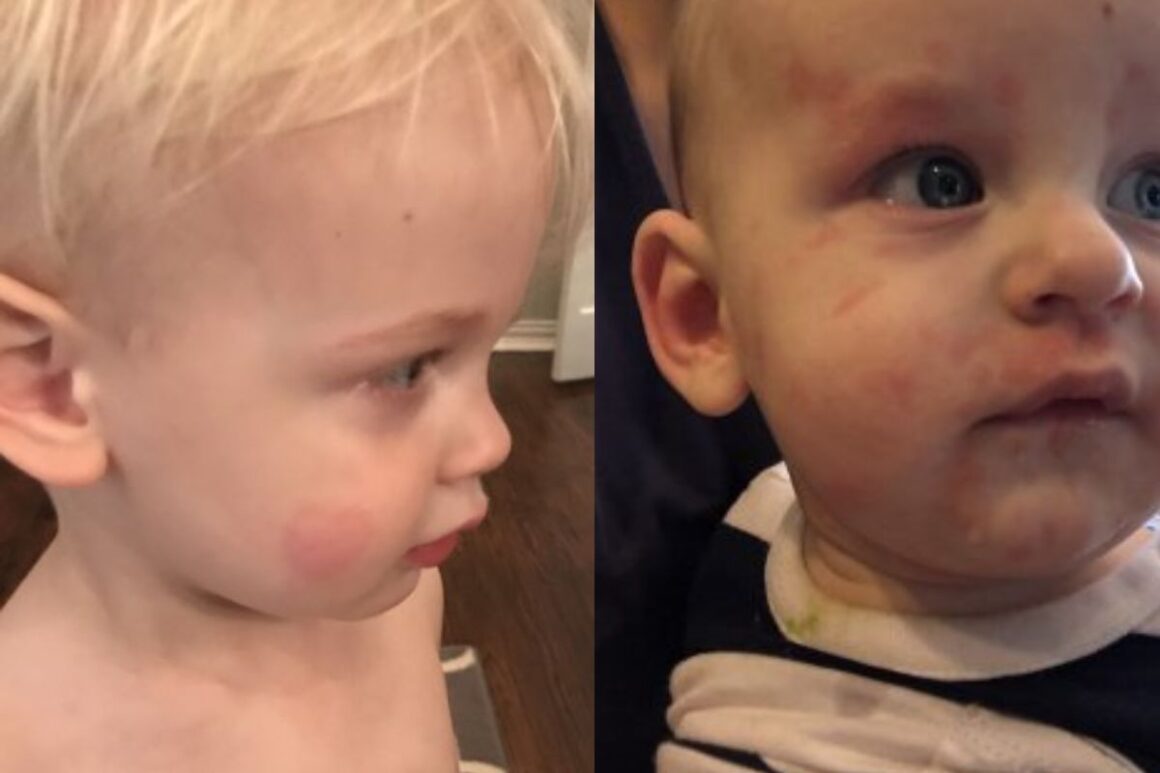 Cucumber Allergy: Symptoms, Rash, and Treatment - Happiness Cucumber